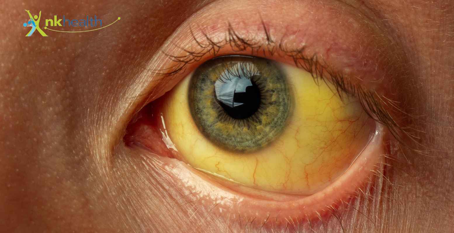 4 Perbedaan Hepatitis A dan B yang Perlu Diketahui